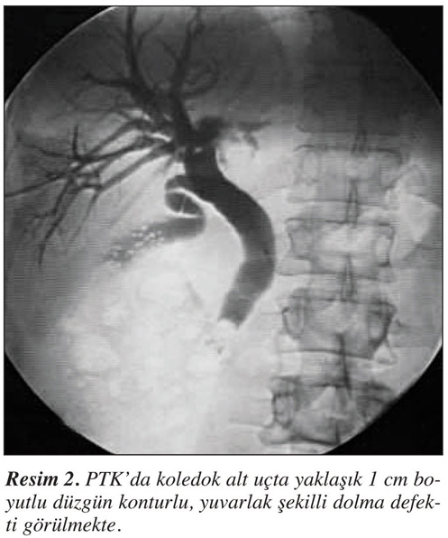 Koledok Alt Uç Taşının Perkütan Tedavisi